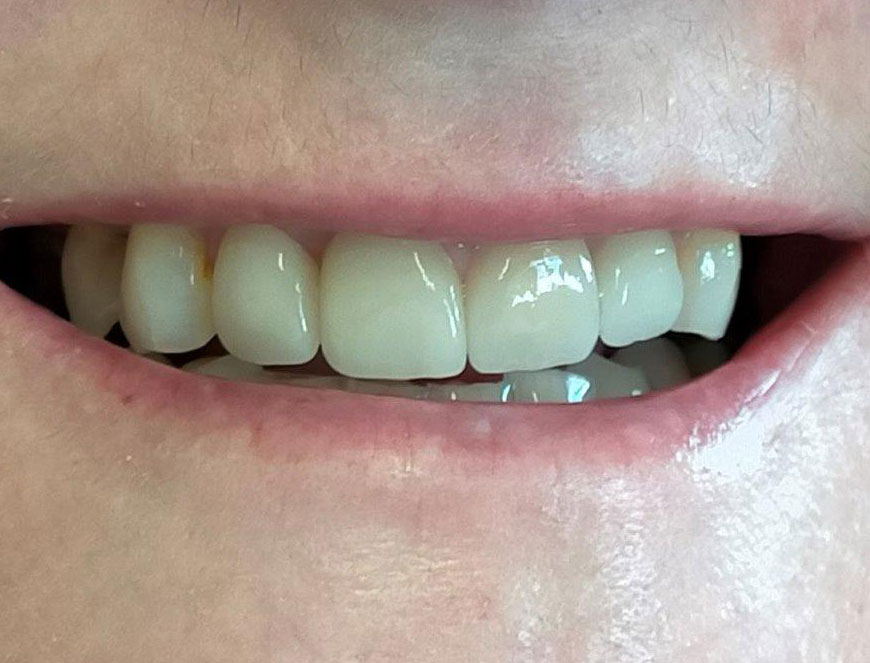 Explore Our Gallery of Teeth Transformations - Hawera Dental Surgery